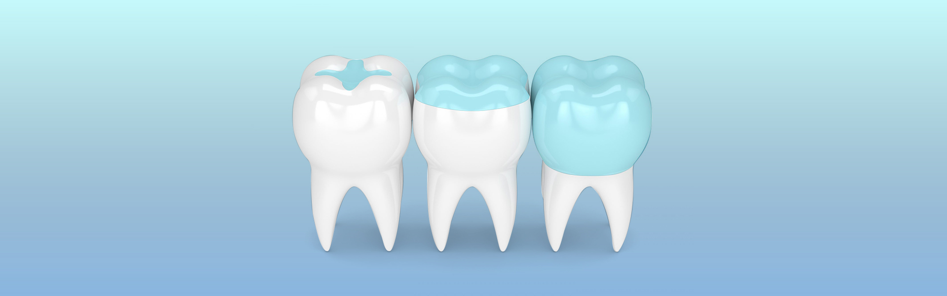 What Are the Differences Between Inlays & Onlays?